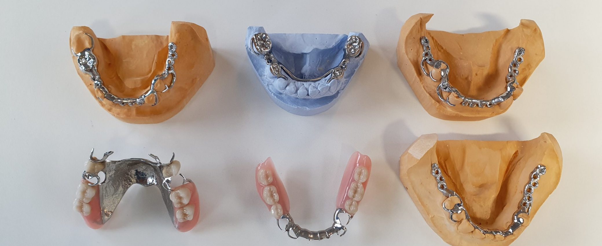 Delprotese – Vestmann Tandteknik